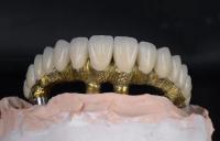 China High Translucency Solid  Implant Supported Crown Customizable For Dental Restoration for sale