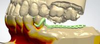 China Digital Metal Framework CAD CAM Dental Design Cocr Material With 3D Printing for sale