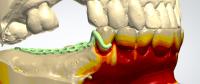 China Digital Metal Framework CAD CAM Dental Design Cocr Material With 3D Printing for sale