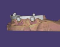 China Customized Dental CAD CAM Design High Precision For Implant Supported Bar for sale