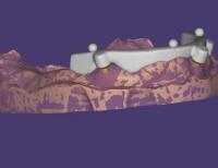 China Customized Dental CAD CAM Design High Precision For Implant Supported Bar for sale