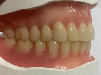 China Hypoallergenic Customized Removable Partial Denture With Pink Gum Color for sale