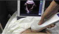 China Portable 4D Wireless Bladder Scanner WIFI Ultrasound Probe for Evaluation of Residual Quality After Urination for sale