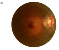 China factory price for the auto Capture and Auto Flash Fundus Camera for Retinal Examination for sale