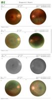 China factory price for the auto Capture and Auto Flash Fundus Camera for Retinal Examination for sale