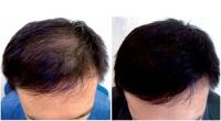 China Red Light Laser Diode Helmet For Hair Growth 1360mW for sale