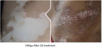 China Blue Excimer Laser Technology FDA CE Vitiligo Laser Treatment for sale