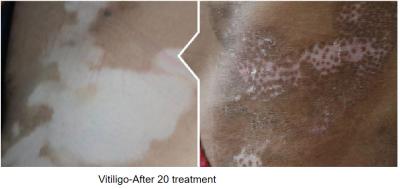 China Blue Excimer Laser Technology FDA CE Vitiligo Laser Treatment for sale