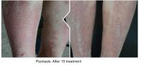 China Light Vitiligo Excimer Laser Machine 9.2kg XeCl Lamp UVB Phototherapy for sale