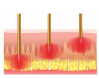 China Fractional Rf Radio Frequency Skin Tightening Microneedle Machine For Beauty Center for sale