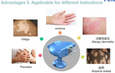 China CE FDA Psoriasis Laser Machine XeCl Lamp Excimer Light Treatment 16cm2 Spot for sale