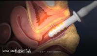 China Radio Frequency RF Vaginal Rejuvenation Skin Non Surgical Noninvasive for sale