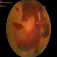 China High Resolution Automated Fundus Camera with FFA or FAF, mosaic function for sale
