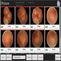 China Hyper Static Non Mydriatic Fundus Camera Machine 180 Degrees for sale