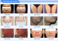 China High Intensity Focused Ultrasound HIFU 3D Machine 1-11 Lines Skin Tightening Lifting for sale