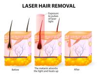 China Laser Hair Removal Machine 808nm Warranty 1 Year Beauty Equipment for sale