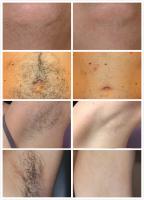 China Laser Hair Removal Machine 808nm Warranty 1 Year Beauty Equipment for sale
