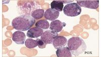 China Leukocyte Peroxidase (POX) Stain (Myeloperoxidase) for sale