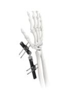 China Orthopedic Wrist External Fixator Standard Single sided Integrated for sale