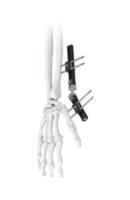 China Orthopedic Wrist External Fixator Standard Single sided Integrated for sale