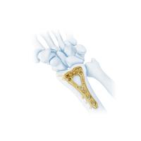 China Medical Orthopedic Multi-Axial Distal Radius Medial Locking Plate for sale