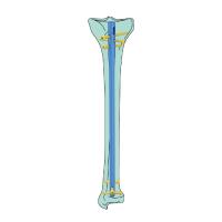 China 8/9/10 Mm Thickness Titanium Intramedullary Nail System Proximal Tibial Interlocking Nail for sale