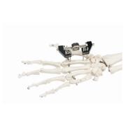 China Factory Price Mini Fragment Orthopedic Orthofix External Fixator With Pins For Finger for sale