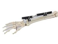 China Sterilized Bone Fracture Distal Radius External Fixator for sale