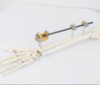 China T Shaped Clamp External Fixator For Distal Radius Fracture OEM for sale