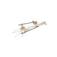 China Aluminum Straight Rod Stryker Hoffmann External Fixator Class I Class III for sale