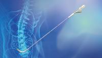 China Percutaneous Curved Kyphoplasty System PCKP Unilateral Puncture Integrally Forming for sale