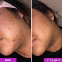 China Alcohol Free Skin Molecules Discoloration Correcting Serum Tranexamic Acid Niacinamide For Dark Age Spots for sale