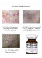China OEM Private Label Meso Luxury Injectable Mesotherapy Serum Acne Scar Removal Skin Whitening Moisturizing Serum for sale