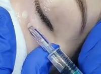China 3 Pins Nanosoft Microneedles Hyaluronic Acid Filler Injection Beauty Micro Needle Mesotherapy For Neck,Eyes With Anti Ag for sale