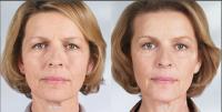 China Poly-Lactic Acid for Stimulating The Regeneration of Collagen Dermal Filler for sale