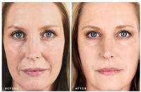 China Hblve Injectable Stimulates Collagen Production  Plla Powder for Restore Youthful Facial for sale
