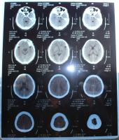 China 13x17 Inch Digital X-ray Film - 195 Micron Blue Medical Laser Film for CT/CR/MRT Imaging for sale