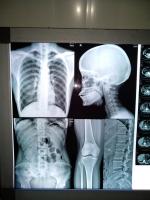 China 13x17 Inch Medical Dry Film for Digital X-Ray Imaging | 330mm x 432mm Size | 210 Micron Thickness for sale