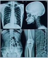 China Medical Dry Film 8x10 to 14x17 Thermal Print PET X Ray Film 204μm for sale