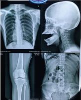 China PET Based Blue Laser X-Ray Film 8x10 Inch (203x254mm) for Medical Digital Imaging CT CR MR Output for sale