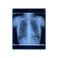 China CE Printable Blue Medical X-Ray Film 11x14 Inch 210 Micron PET Inkjet Film for Canon Epson Printers for sale
