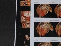 China 240gsm 180 Micron Medical Inkjet Film for CT Scan and Ultrasound Imaging - A3/A4/13x17 Sizes for sale