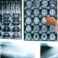 China Inkjet Blue Medical Dry Film Transparent Xray Film 14x17 for CT DR MRI Radiological Device for sale