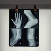 China Medical X Ray Blue Film 200±5μM High Sharpness Low Fog Level 8x10 to 14x17 for sale