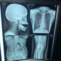 China Blue Laser X Ray Film 13x17 Inch 190μm Thickness for Medical Diagnostic Imaging for sale