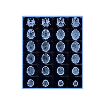 China Blue Medical X Ray Film for Inkjet Printers 10x12 inch 210 Micron High Sharpness Low Fog for sale