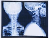 China Blue Laser Medical Dry X-Ray Film 35x43 cm for Radiography Examination for sale