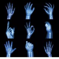 China Inkjet Printable PET Dry Laser X Ray Film Blue Base 14x17in for Diagnostic Imaging for sale