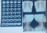 China Medical Inkjet X Ray Dry Film 210 Microns for DR CR MRI Printer CE ISO for sale