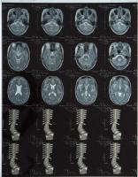 China Inkjet Medical Dry Film 10x12 Inch Blue for X-ray Image Output Printing for sale